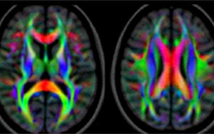 Neurodegeneration : Research in Sussex Neuroscience : Sussex ...